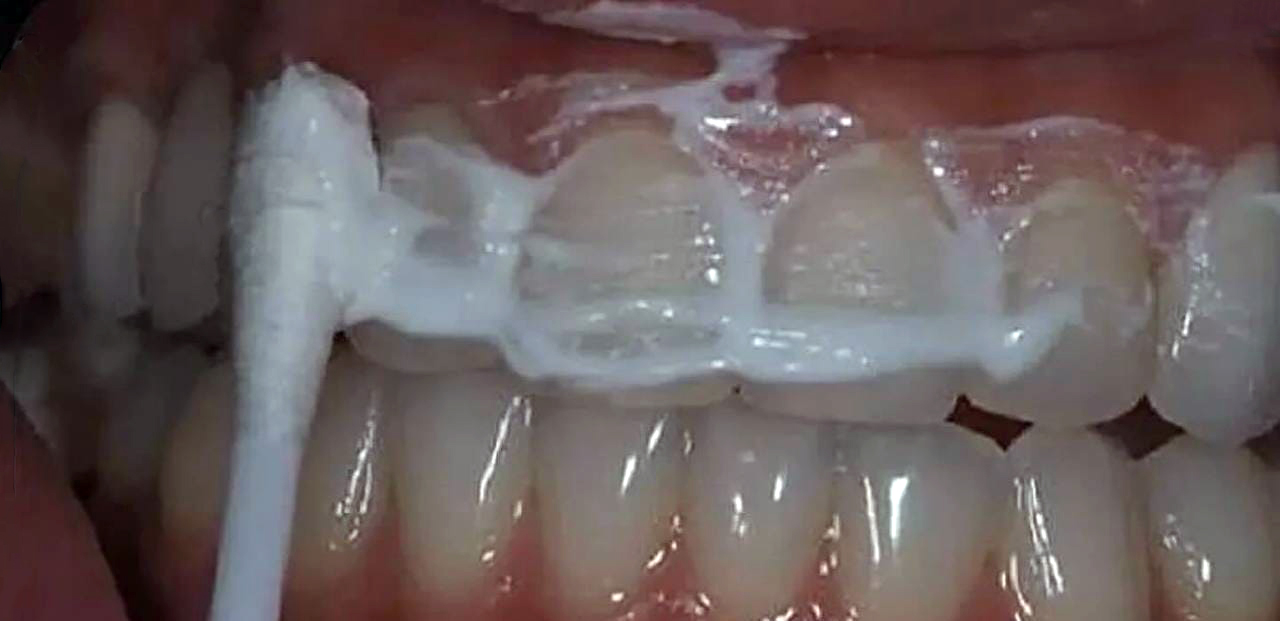 a safe method for whiter teeth | Waikanae Watch